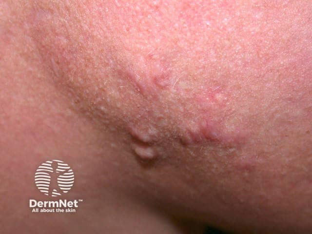 DermNet® - acne-face_48 image